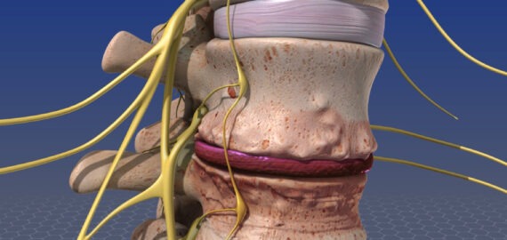 Spinal Infection Treatment - Kanawade Hospital